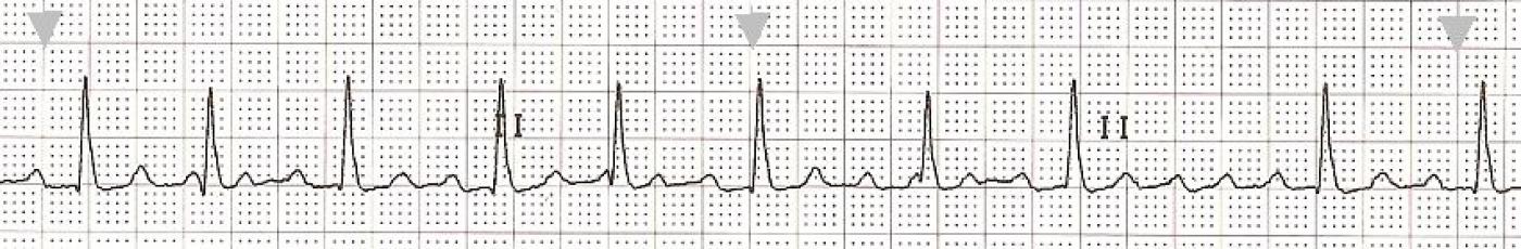 Ecg Basics Atrial Flutter With Variable Conduction Ecg Guru